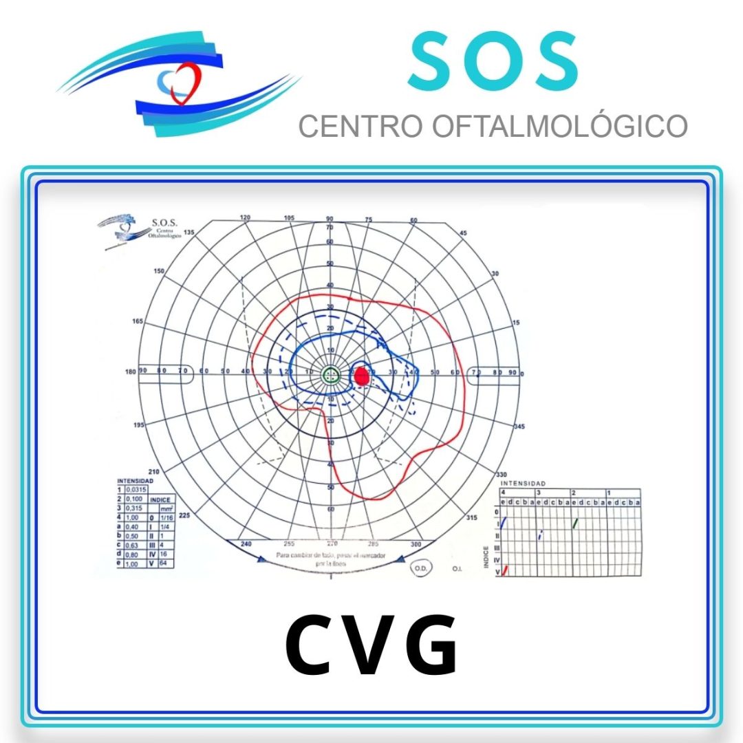CVG o Campo Visual Goldman – Centro Oftalmológico SOS