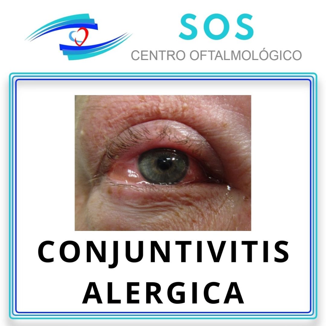 Conjuntivitis – Centro Oftalmológico SOS